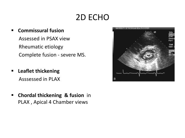 PPT - ECHOCARDIOGRAPHIC EVALUATION OF MITRAL STENOSIS PowerPoint ...