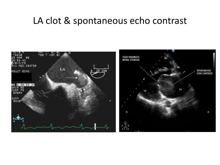 PPT - ECHOCARDIOGRAPHIC EVALUATION OF MITRAL STENOSIS PowerPoint ...
