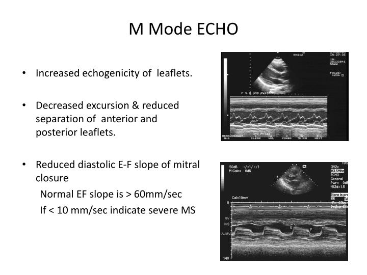 PPT - ECHOCARDIOGRAPHIC EVALUATION OF MITRAL STENOSIS PowerPoint ...