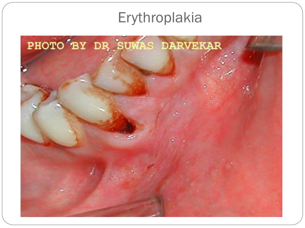 PPT - Carcinoma of Tongue (Oropharyngeal) PowerPoint Presentation, free ...