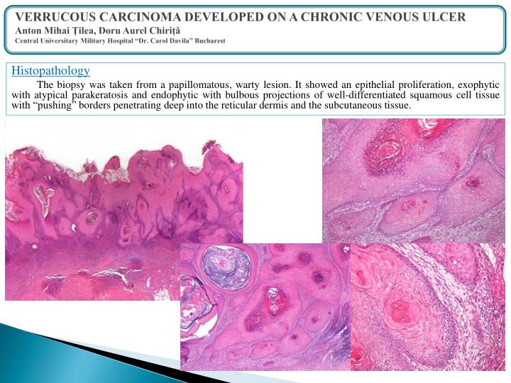 PPT - Introduction Verrucous carcinoma is a form of well-differentiated ...