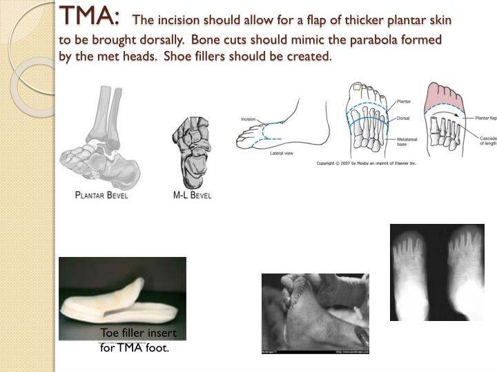 PPT - Forefoot Amputations PowerPoint Presentation - ID:2188409