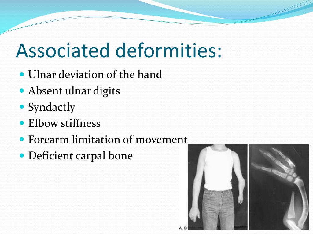 PPT - Ulnar Club hand deformity Ali Dianat Hand orthopedic surgoen ...