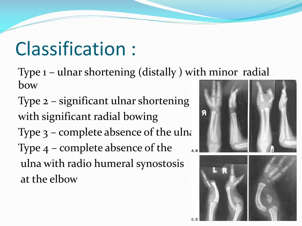 PPT - Ulnar Club hand deformity Ali Dianat Hand orthopedic surgoen ...