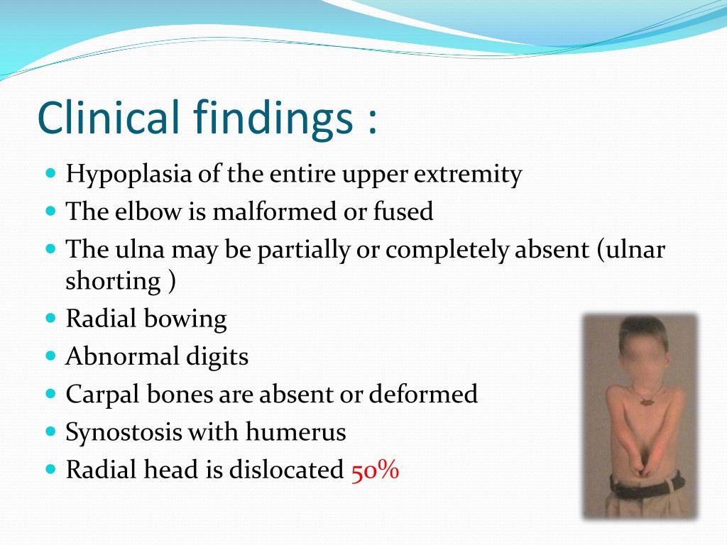 PPT - Ulnar Club hand deformity Ali Dianat Hand orthopedic surgoen ...