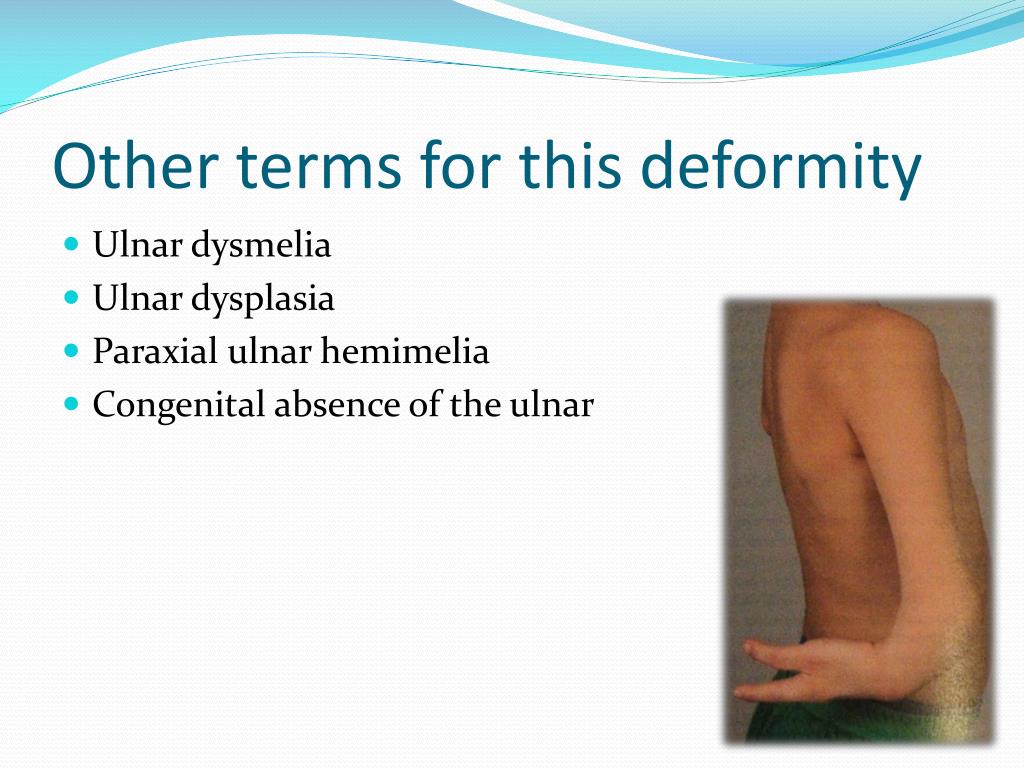 PPT - Ulnar Club hand deformity Ali Dianat Hand orthopedic surgoen ...