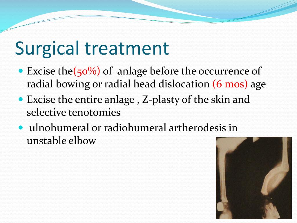 PPT - Ulnar Club hand deformity Ali Dianat Hand orthopedic surgoen ...