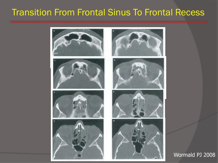 PPT - Frontal Sinus Surgery PowerPoint Presentation - ID:2192513