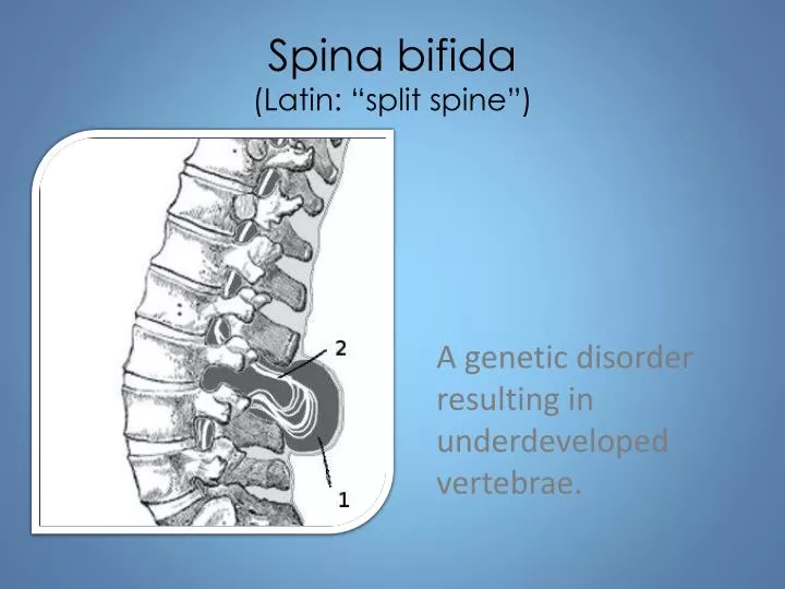 Ppt Spina Bifida Latin “split Spine” Powerpoint Presentation Free