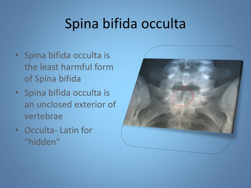 Ppt Spina Bifida Latin “split Spine” Powerpoint Presentation Free