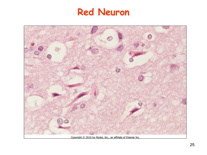 PPT - Edema PowerPoint Presentation - ID:2194543