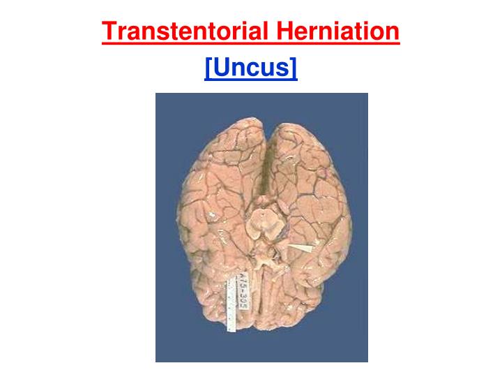 PPT - Edema PowerPoint Presentation - ID:2194543