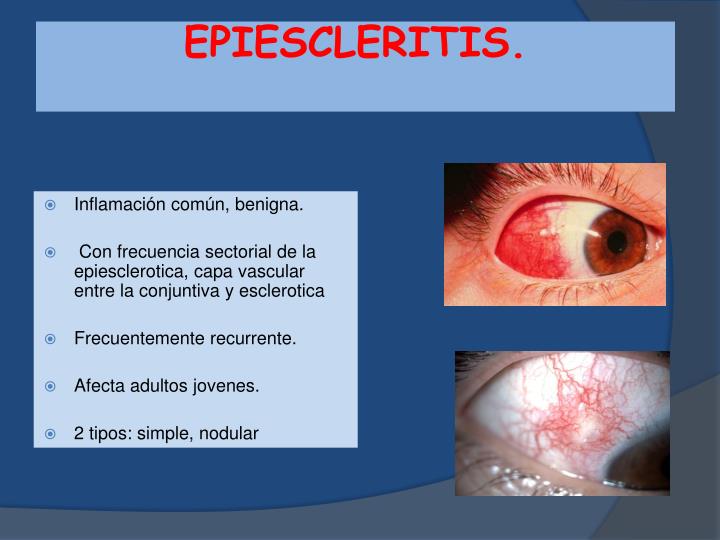 PPT - OJO ROJO PowerPoint Presentation - ID:2203026