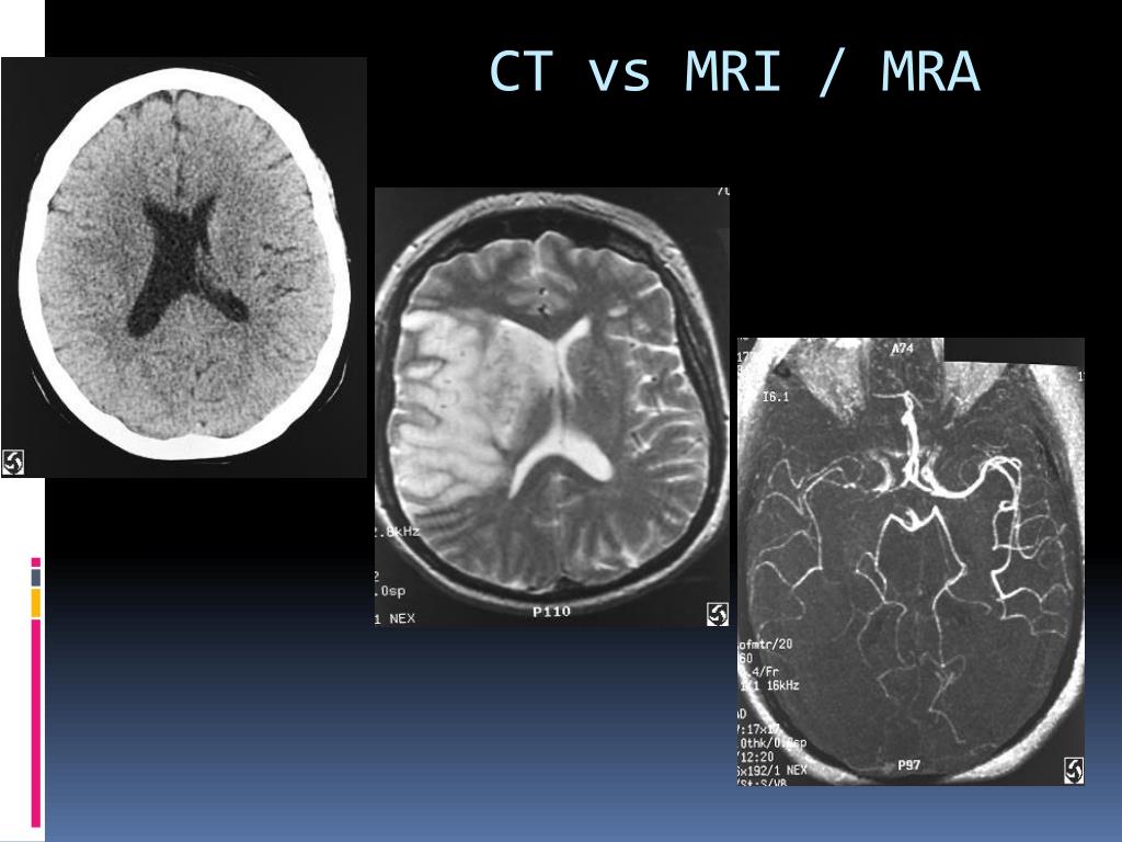 PPT - Dr Aaron de Souza MD, DM, DNB, MNAMS Consultant Neurologist ...