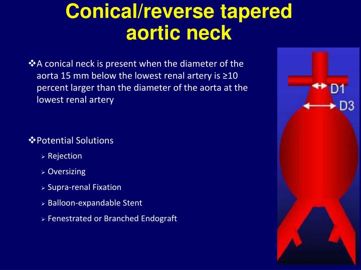 PPT - Endovascular aneurysm repair ( EVAR) PowerPoint Presentation - ID ...