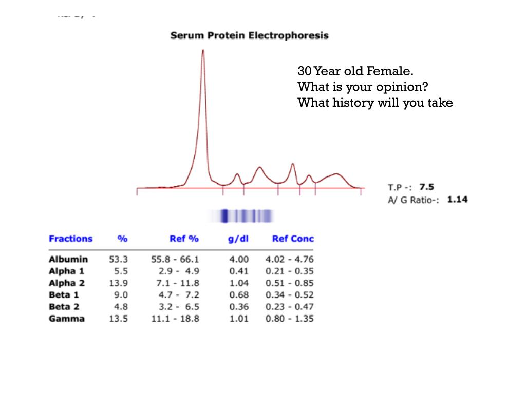 PPT - Serum Protein Electrophoresis with Immunofixation PowerPoint ...