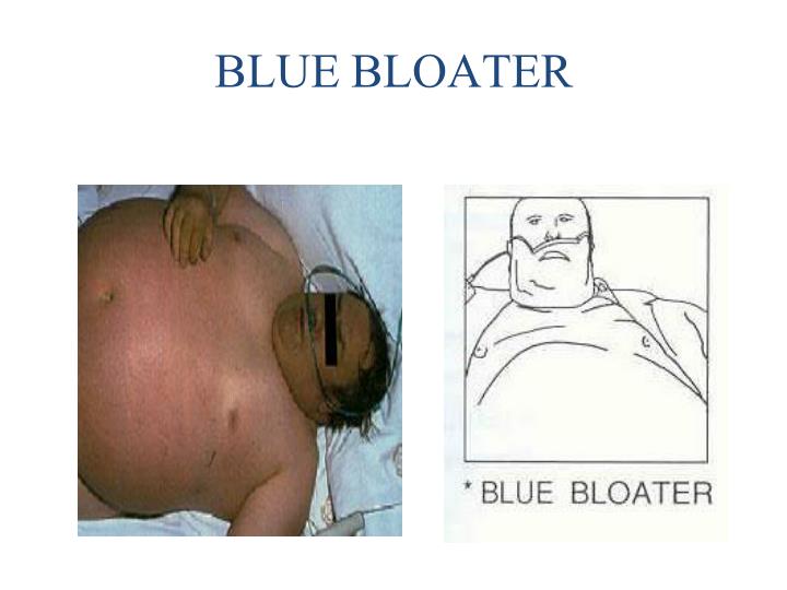 PPT - COPD Chronic Obstructive Pulmonary Disease PowerPoint ...