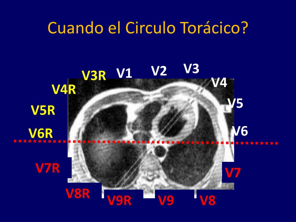 PPT - Cardiopatía Isquémica para el Internista PowerPoint Presentation ...