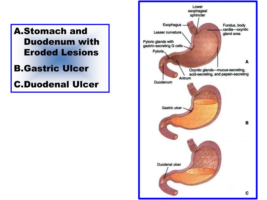 PPT - Medical Nutrition Therapy for Gastrointestinal Tract Disorders ...