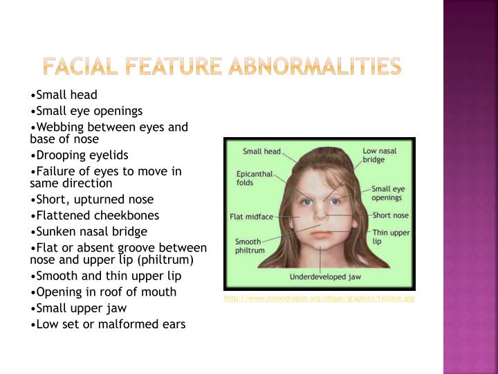 PPT - Fetal Alcohol Spectrum Disorder PowerPoint Presentation - ID:2212323