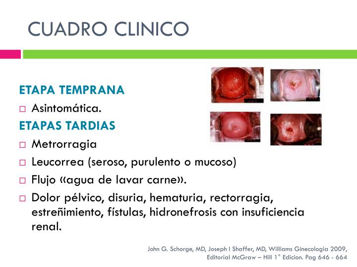 PPT - Cáncer Cervicouterino PowerPoint Presentation - ID:2213699