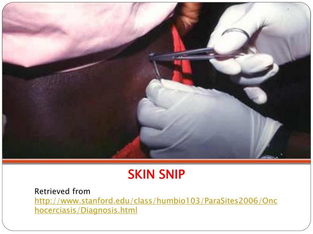 PPT - ONCHOCERCIASIS: THE PUBLIC HEALTH IMPACT IN AFRICA PowerPoint ...