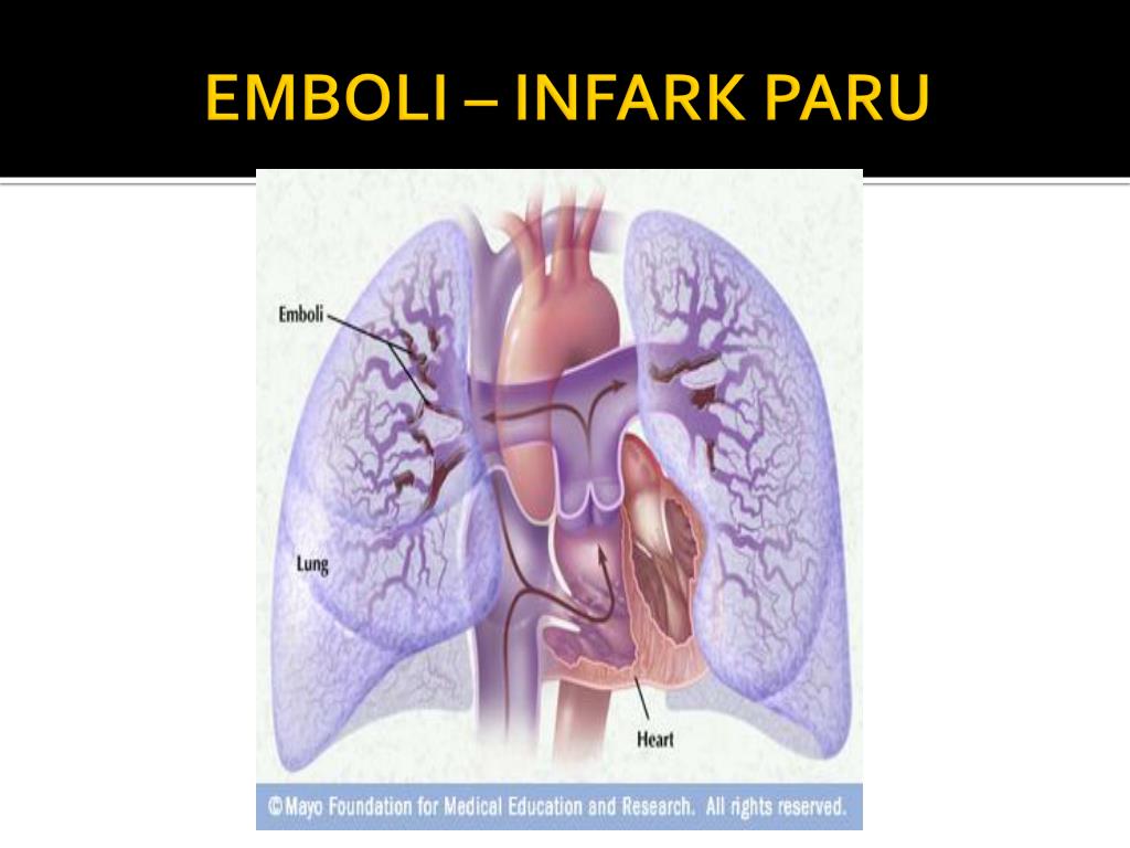 PPT - dr. Arimbi,Sp.P Bag. Ilmu Penyakit Paru FK - UWKS PowerPoint ...