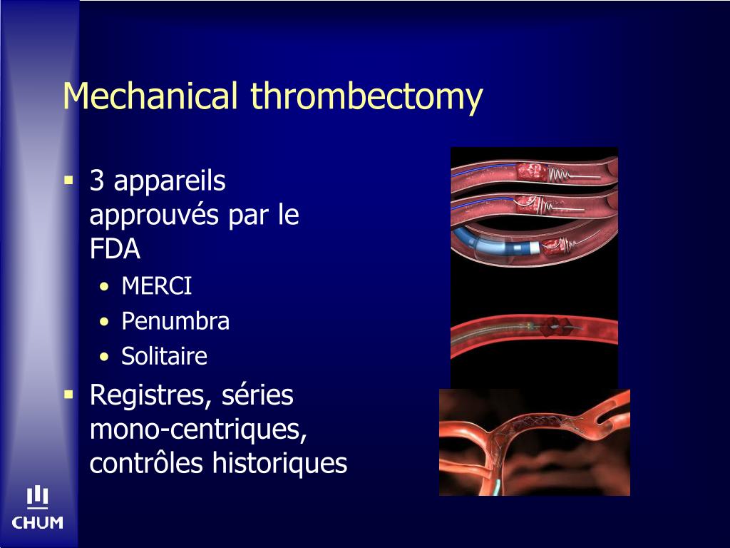 PPT - Endovascular treatment of acute ischemic stroke PowerPoint ...