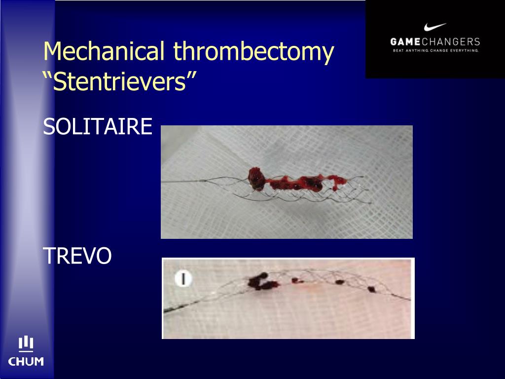 PPT - Endovascular treatment of acute ischemic stroke PowerPoint ...