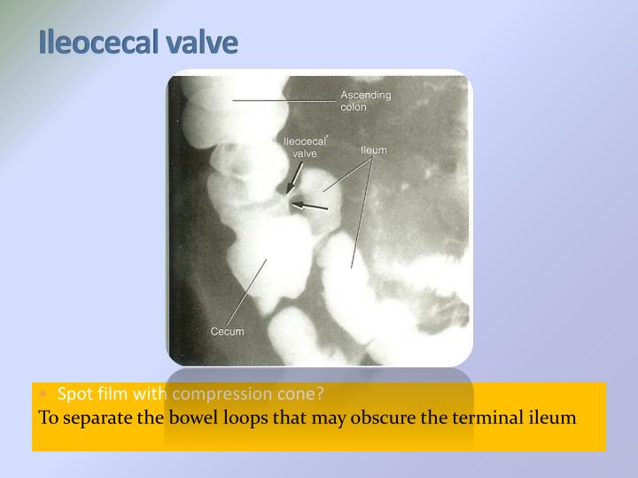 PPT - Small Bowel procedures PowerPoint Presentation - ID:2220143