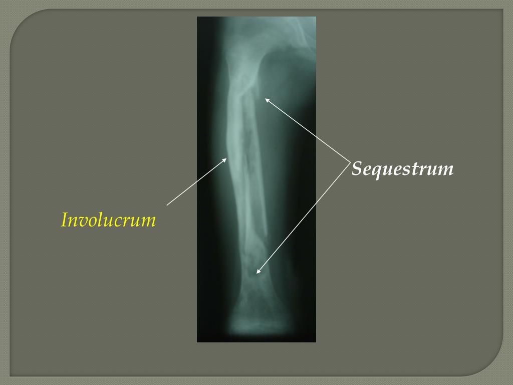 PPT - Chronic osteomyilitis of femur with a large diaphysial sequestrum ...