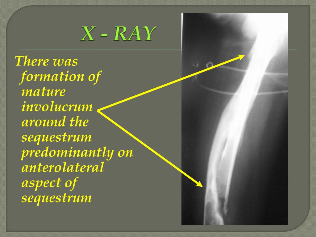 PPT - Chronic osteomyilitis of femur with a large diaphysial sequestrum ...