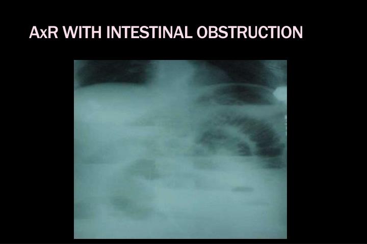 PPT - ABDOMINAL TUBERCULOSIS PowerPoint Presentation - ID:2221374