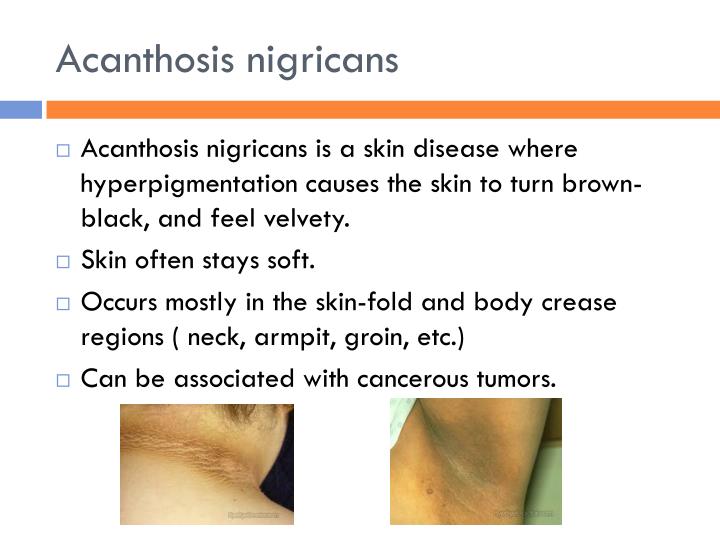 PPT - Acanthosis Nigricans (Darkened Skin) PowerPoint Presentation - ID ...