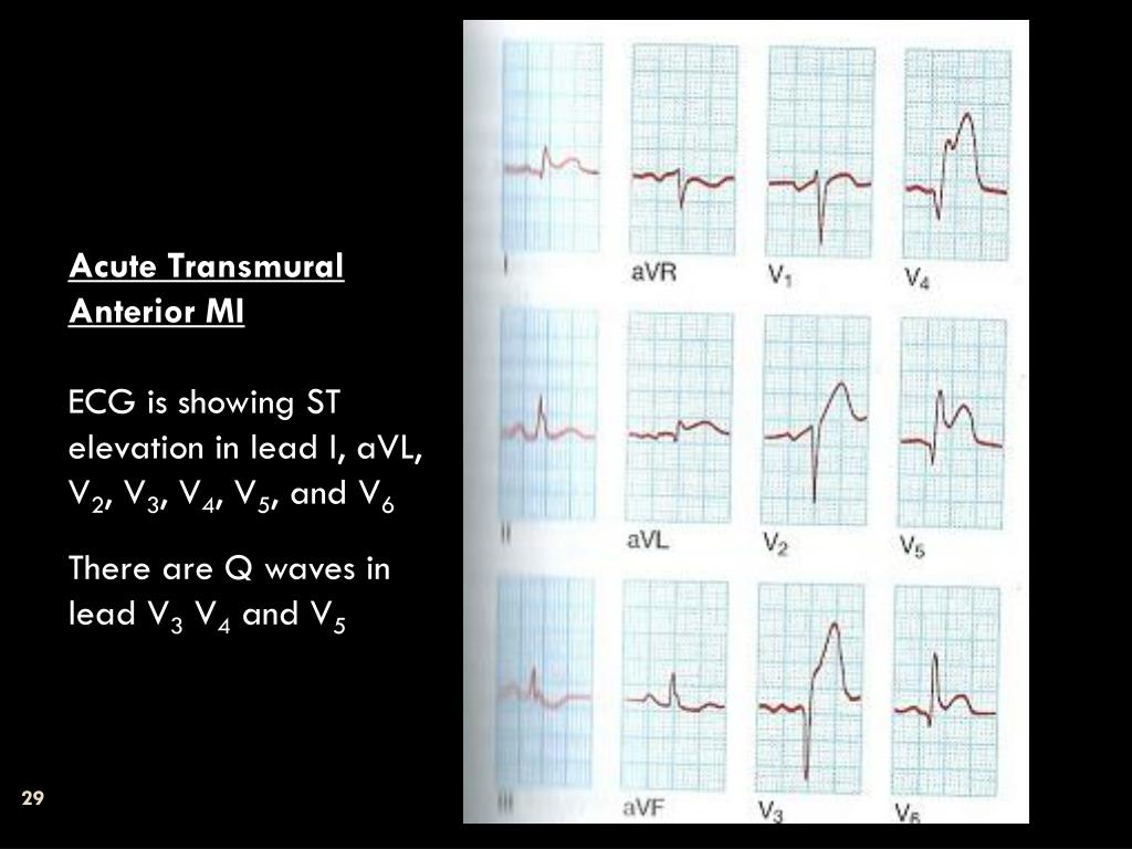PPT - TREATMENT of CHRONIC STABLE ANGINA AND acute coronary syndrome ...