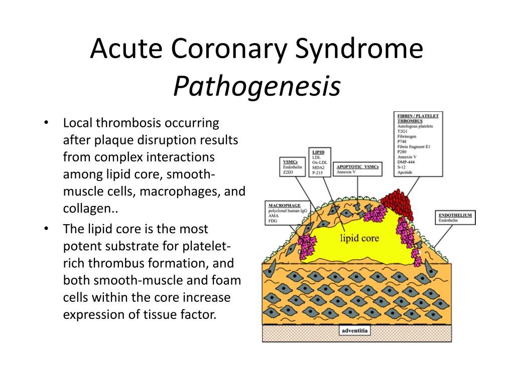 PPT - Acute Coronary Syndrome The Essentials PowerPoint Presentation ...