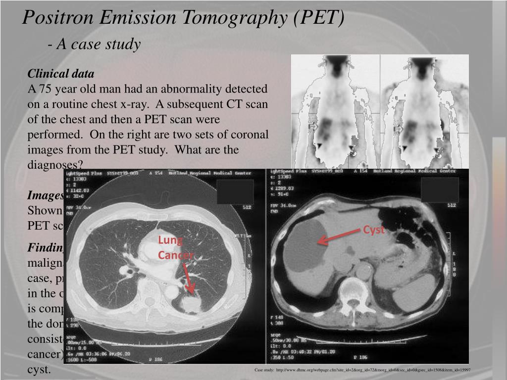PPT - Radioactivity, Nuclear Medicine & PET Scans PowerPoint ...