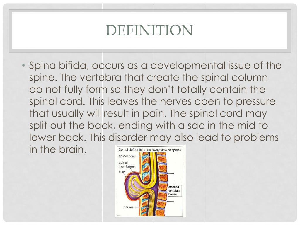 Ppt Spina Bifida Powerpoint Presentation Free Download Id 2225273