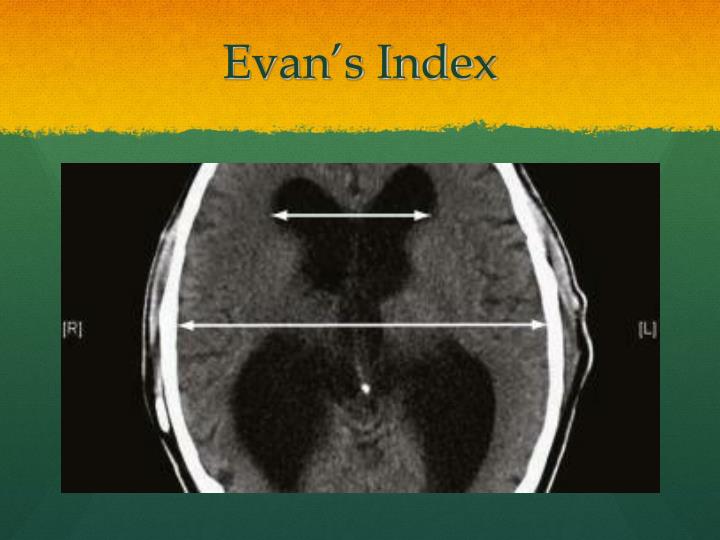 PPT - NORMAL PRESSURE HYDROCEPHALUS PowerPoint Presentation - ID:2225352