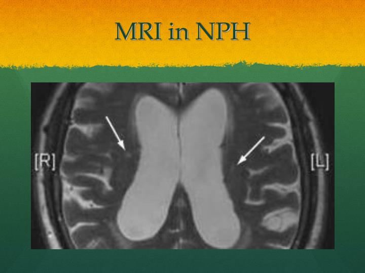 PPT - NORMAL PRESSURE HYDROCEPHALUS PowerPoint Presentation - ID:2225352