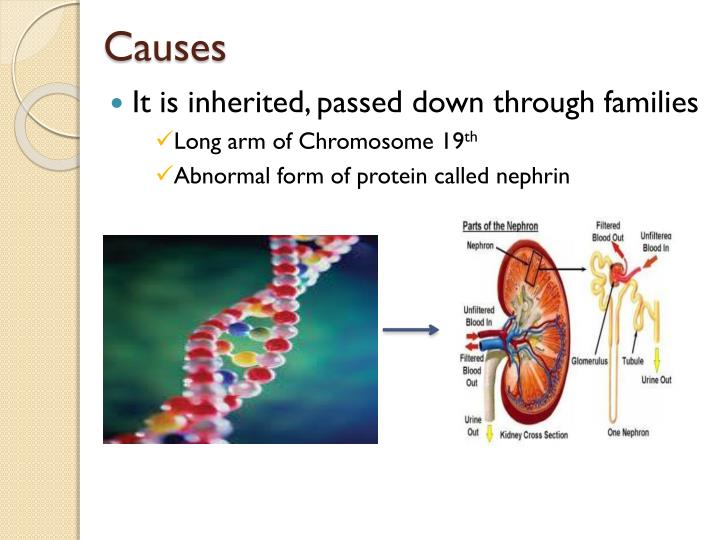PPT - Nutrition Implications of Congenital Nephrotic Syndrome ...