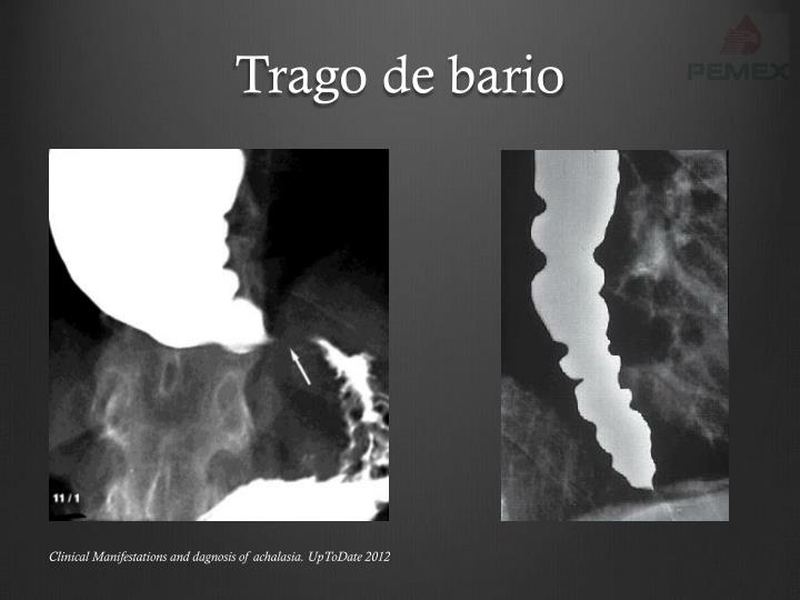 PPT - Patología esofágica PowerPoint Presentation - ID:2237697