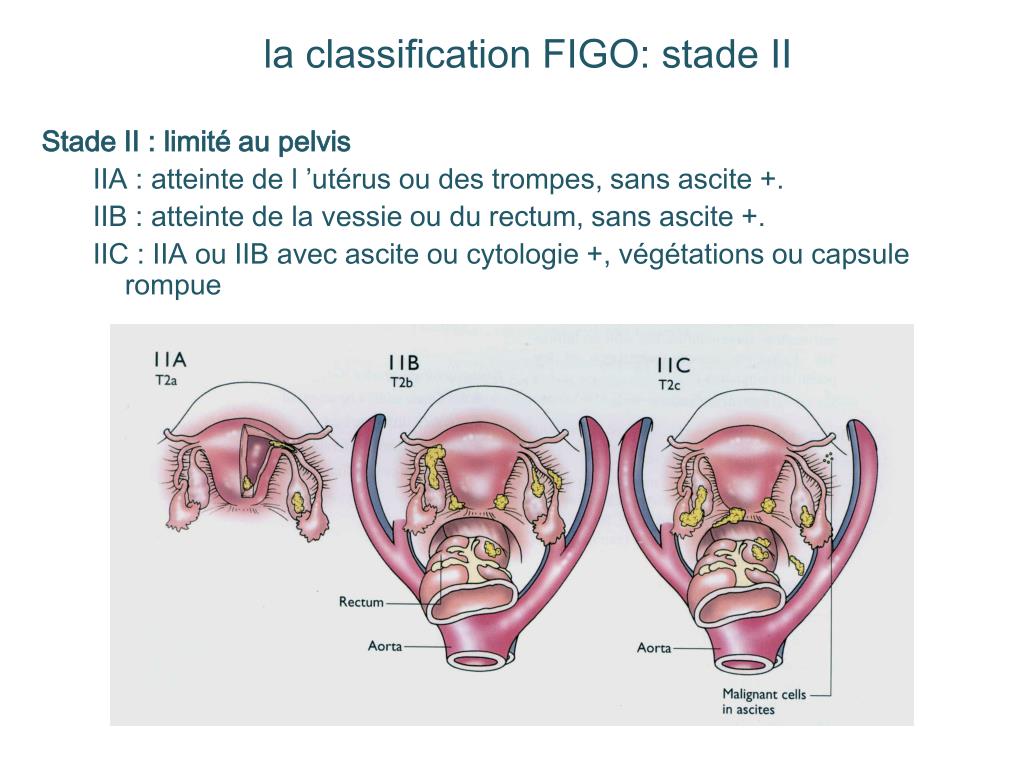 PPT - Protocole de traitement du cancer de l’ovaire Professeur Denis ...