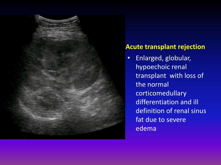 PPT - Role of Ultrasound In Renal Transplantation PowerPoint ...