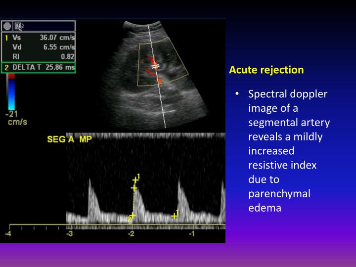 PPT - Role of Ultrasound In Renal Transplantation PowerPoint ...