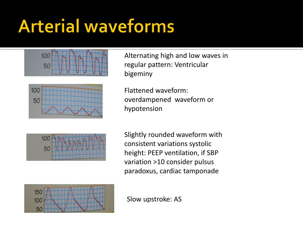 Abnormal Arterial Line Waveforms Abnormal Arterial Line Waveforms