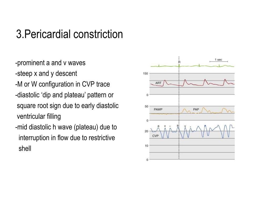 PPT - Pulmonary artery catheter for cardiac pressure monitoring and its ...