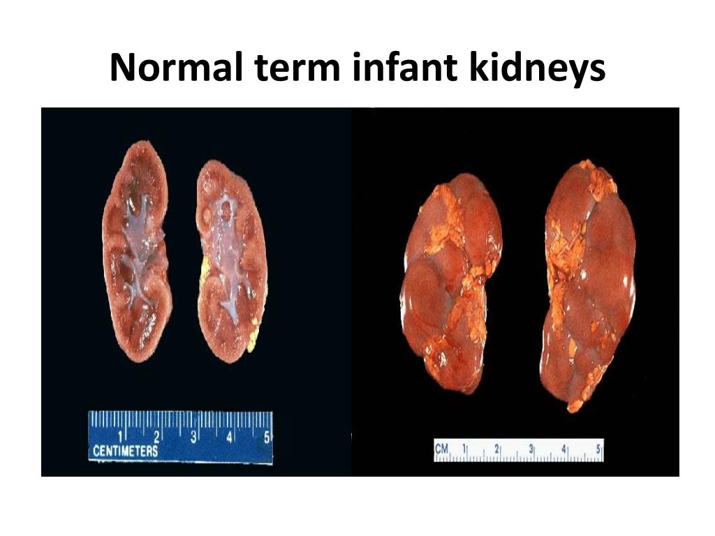 PPT - CYSTIC DISEASES OF THE KIDNEY PowerPoint Presentation, free ...