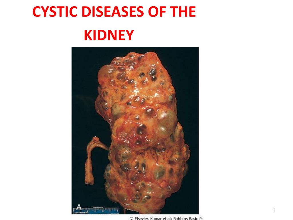 PPT - CYSTIC DISEASES OF THE KIDNEY PowerPoint Presentation, free ...