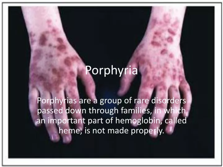 PPT - Porphyria PowerPoint Presentation, free download - ID:2240251